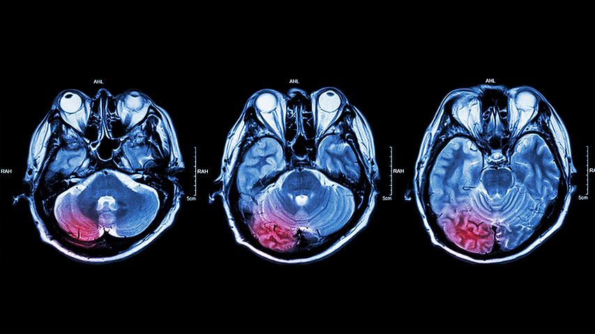 Academic contributes to report warning hidden toll of brain injury ...