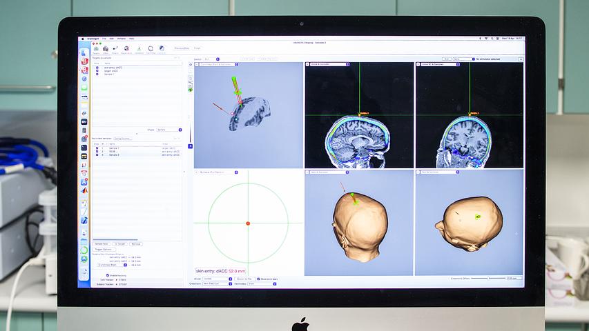 Multi-site and state-dependent effects of Transcranial Ultrasound ...